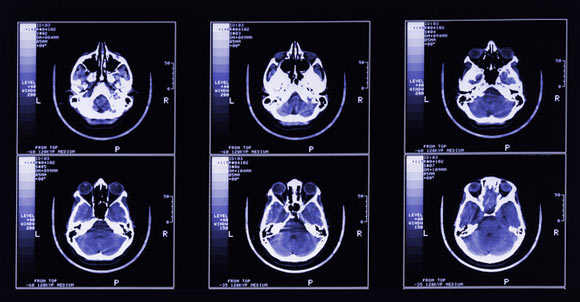 Subdural Electrodes Beneficial for Epilepsy Monitoring — Lucia Zamorano ...